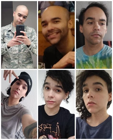 Months Hrt Year Old Non Binary Woman No Makeup Sessions Of Laser Scrolller