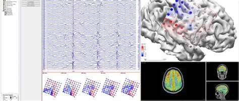 Curry Neuro Imaging Suite For Epilepsy Evaluation Compumedics Neuroscan