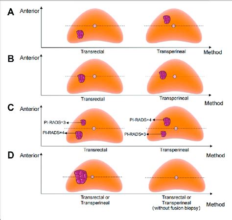 Biopsy Approach Of The Personalized Pattern A Mri Visible Prostate Download Scientific