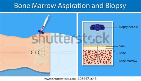 11 Nurse Bone Marrow Specimen Stock Vectors And Vector Art Shutterstock