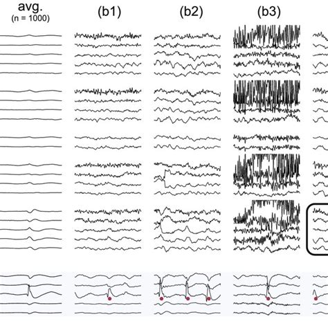 Examples Of Scalp Eeg Waveforms Associated With Intracranial Ieds A