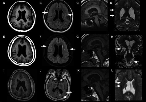 Identification And Clinical Characteristics Of A Novel Missense Adgrg1 Variant In Bilateral