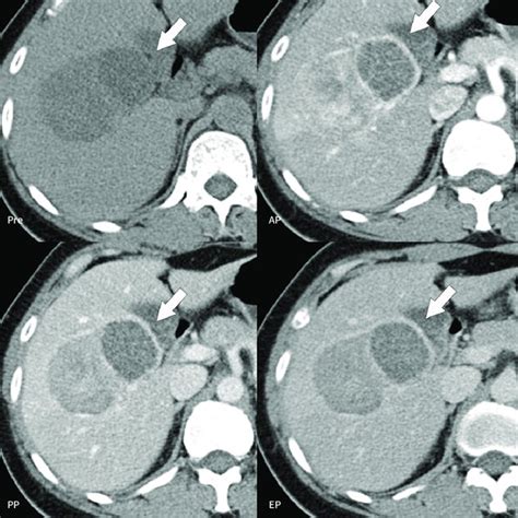 Intrahepatic Cholangiocarcinoma Arising From A Biliary Adenofibroma A