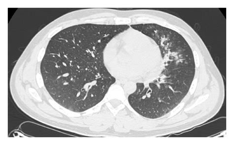 Ct Chest Of The First Patient Showing Diffuse Interstitial Thickening Download Scientific