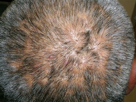 Scalp Cellulitis