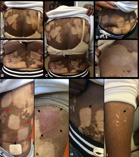 Chemical Leukoderma A Rare Adverse Effect Of The Rotigotine Patch Pmc