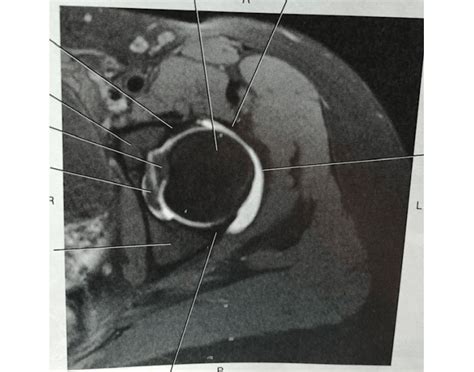 Axial Mr Hip Arthrogram Quiz