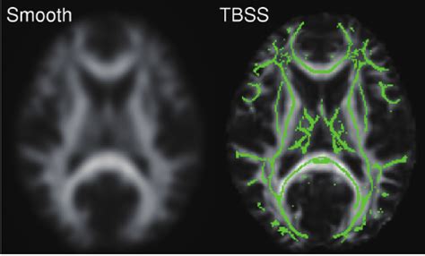 Voxel Based Techniques For Analyzing DTI Parameters In Conventional Download Scientific