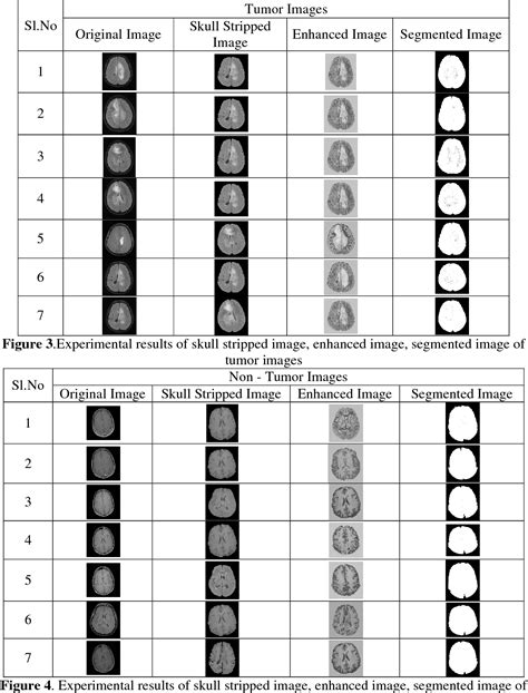 Figure 1 From Identifying Brain Tumour From Mri Image Using Modified