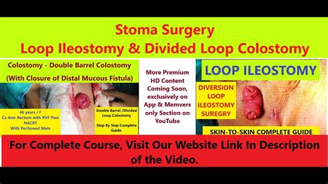 Double Barrel Ileostomy