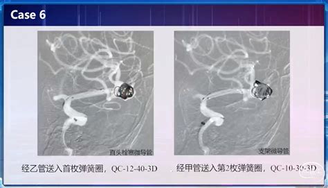 【建议收藏】神经介入手术操作技术：颅内动脉瘤介入治疗弹簧圈选择 脑医汇