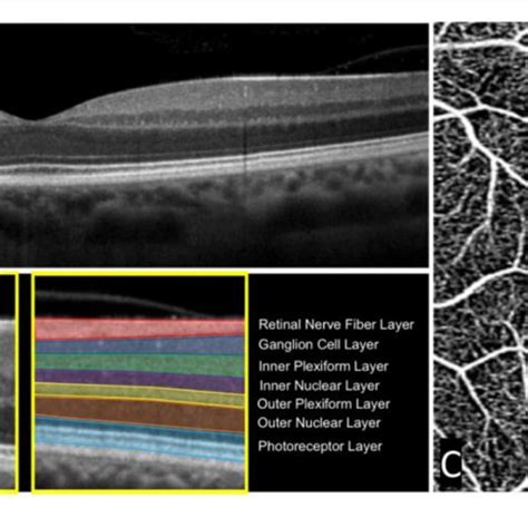 Single Cross Sectional Oct Scan And Accompanying Oct Angiogram In A