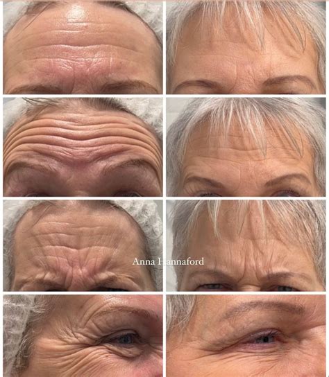 Botox Before And After Photos And Everything You Need To Know