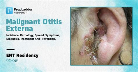 Malignant Otitis Externa Symptoms Diagnosis And Treatment