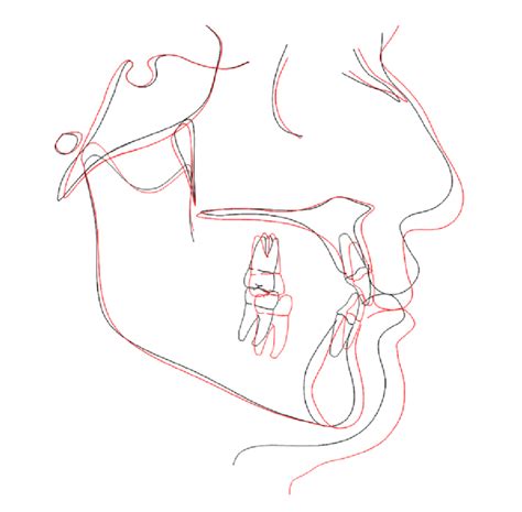 Cephalometric Tracing Of A Male Individual At 14 Black Lines And 63
