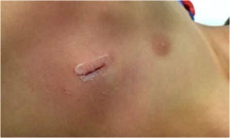 The Evolving Role Of Insertable Cardiac Monitors In Patients With Congenital Heart Disease