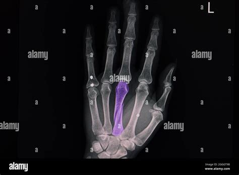 Metacarpal Shaft Fracture