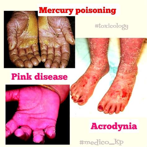 Mercury Poisoning