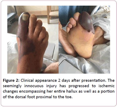 Dorsalis Pedis Flap