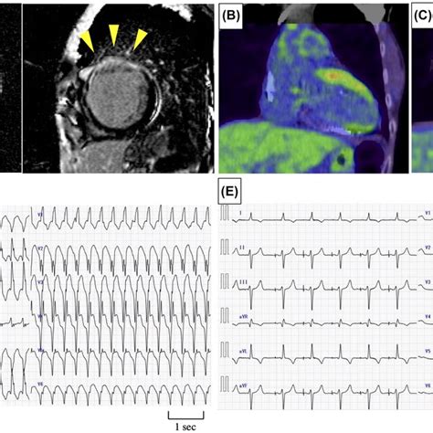 A Activation Map During Vt Shows The Earliest Activation Site In The Download Scientific