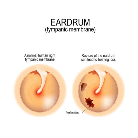 What Causes Your Eardrum To Rupture Annapolis And Severna Park Md