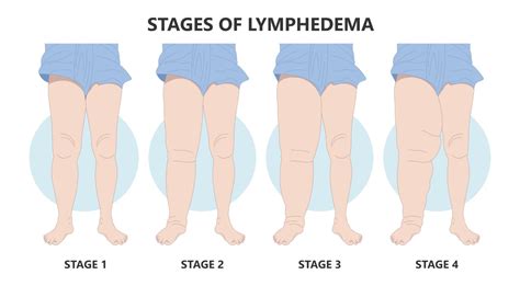 Lymphoedema Clinic Lymphoedema Practitioner