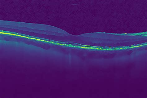 Drusen Object Detection Model By Amd