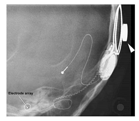 Cochlear Implant Surgery Procedure Benefits And Recovery Guide