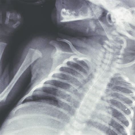 Pdf Nebulized Rhdnase Therapy In Newborn Infants With Atelectasis