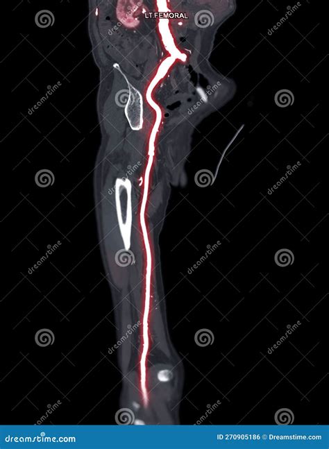Cta Femoral Artery Run Off Mpr Curve Showing Left Femoral Artery For Diagnostic Acute Or Chronic