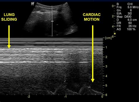 2 Lung Ultrasound Pre Reading For Fcus Course Intensive Care Network