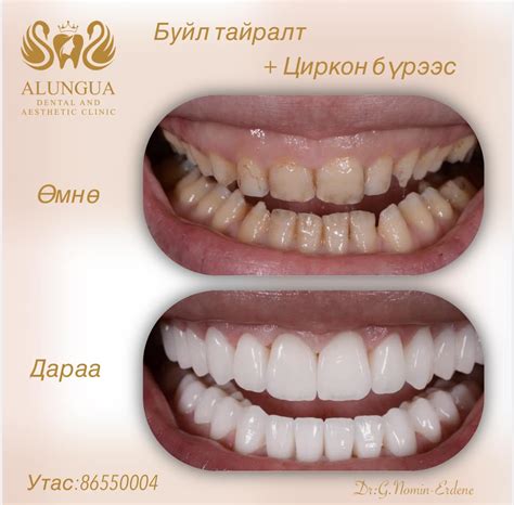 Шүдний бүрээс хийлгэх өртөг яагаад өндөр байдаг вэ гэж үү Шүд гэмтвэл