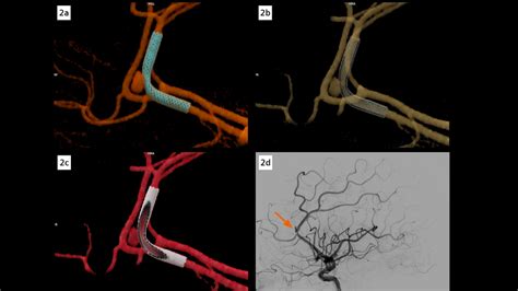 Follow Up On An Unruptured Intracranial Aneurysm Treated With A Flow Diverter Siemens Healthineers