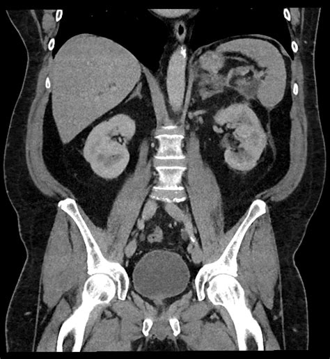 file igg4 related autoimmune cholangitis pancreatitis and pseudotumor