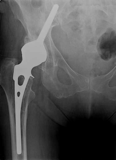Plain Anteroposterior Radiograph Of A Ring Prosthesis Showing A Maximum