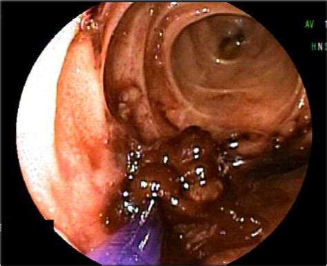 Figure 4 From Severe Portal Venous Bleed During Ercp Treated With Eus Guided Hepaticogastrostomy