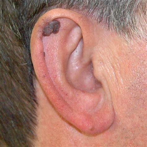 Pdf Bilateral Auricular Classic Kaposis Sarcoma
