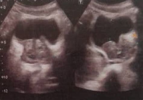 Homogeneous Prostate Hypertrophy With Significant Post Void Residual