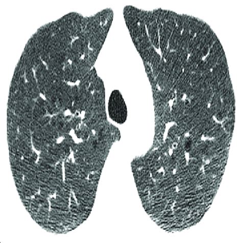 Mild Centrilobular Emphysema Centrilobular Lucencies Involve Less Than