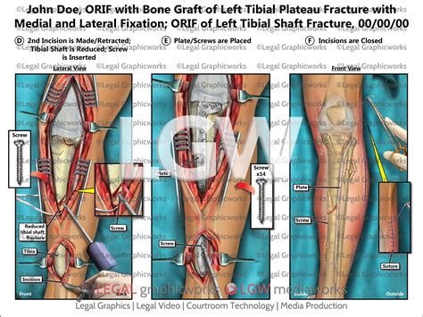 Orif With Bone Graft Of Left Tibial Plateau Fracture With Medial And L Lgwgo