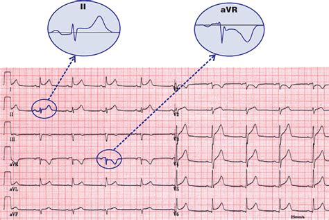 Pericarditis Ecg Book
