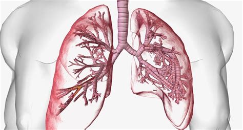 Premium Photo Bronchiectasis Affecting The Lungs Characterized By