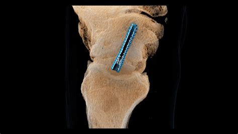 Photon Counting Ct Musculoskeletal Imaging Siemens Healthineers Usa