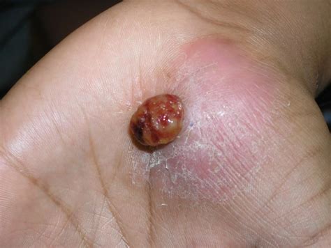 Pyogenic Granuloma Finger