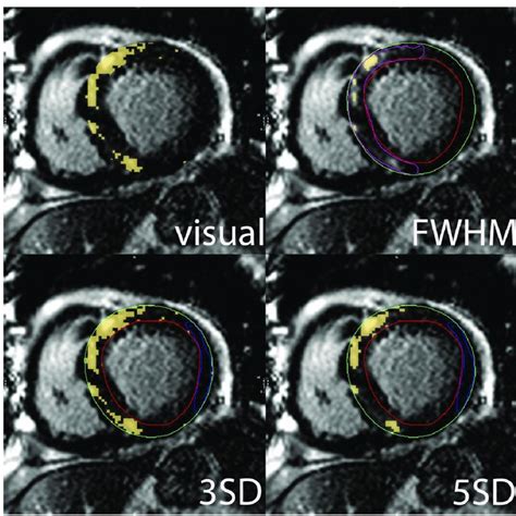 Manual Segmentation And Semi Automated Quantification Of Download