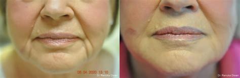 Juvederm For Vertical Lip Lines Before And After Results Fillersupplies