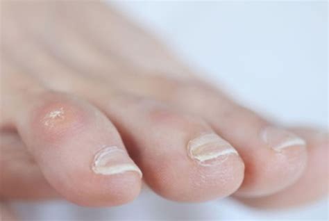 Corn Or Verruca How To Know The Difference