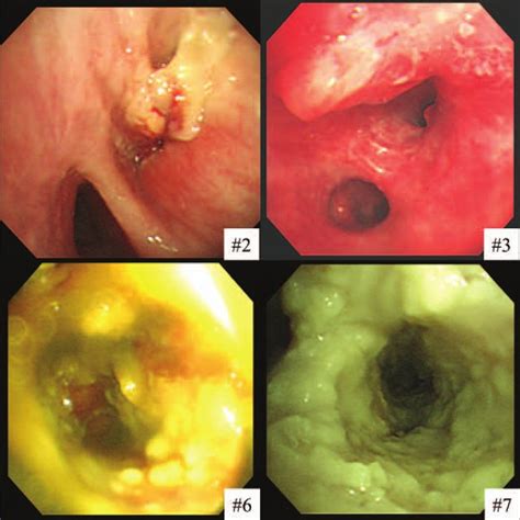 Bronchoscopic Findings Of Candida Tracheobronchitis Numbers Are The
