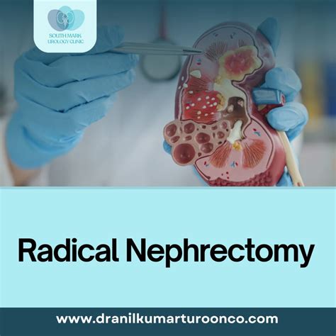 Best Robotic Radical Nephrectomy Treatment In South India