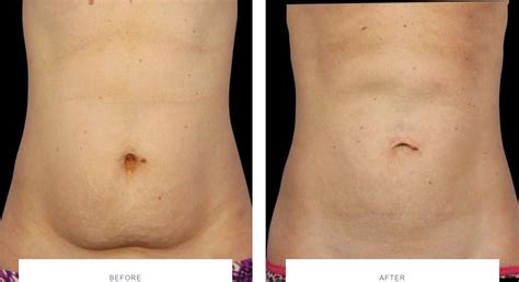 What Does Belly Fat Look Like Atelier Yuwaciaojp